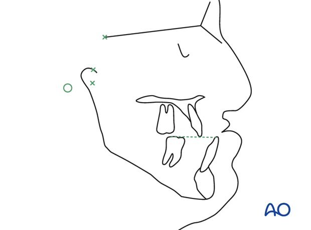 Le Fort I osteotomy - Distraction for Bilateral cleft lip and/or palate