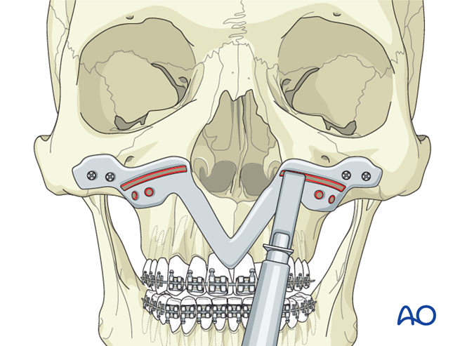 Le Fort I osteotomy - Distraction for Bilateral cleft lip and/or palate