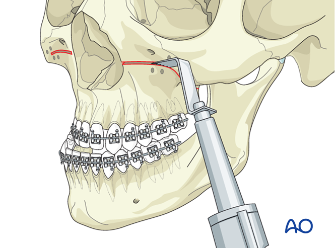 Le Fort I osteotomy - Distraction for Bilateral cleft lip and/or palate