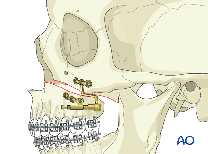 Le Fort I osteotomy - Distraction for Bilateral cleft lip and/or palate