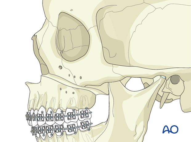 Le Fort I osteotomy - Distraction for Bilateral cleft lip and/or palate