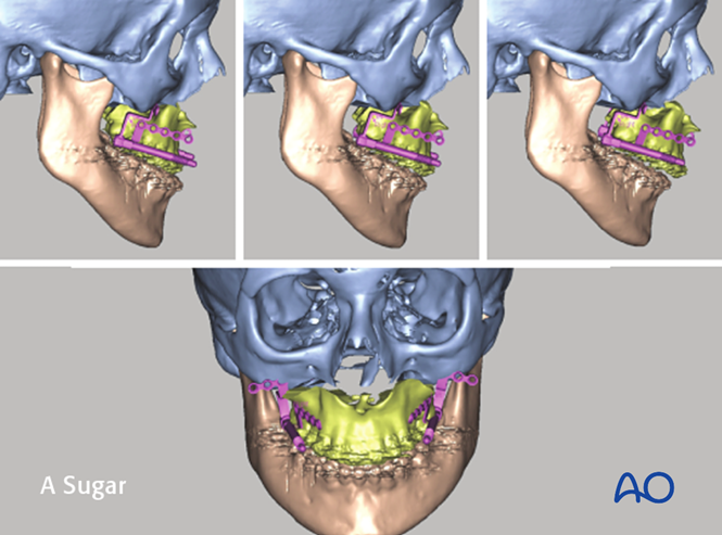Le Fort I osteotomy - Distraction for Bilateral cleft lip and/or palate