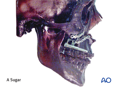 Le Fort I osteotomy - Distraction for Bilateral cleft lip and/or palate