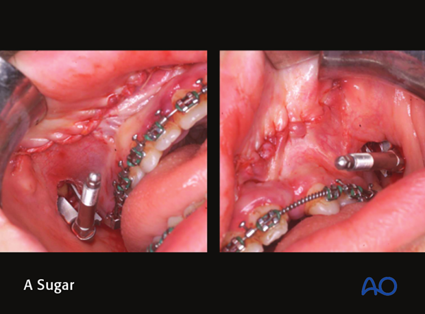Le Fort I osteotomy - Distraction for Bilateral cleft lip and/or palate