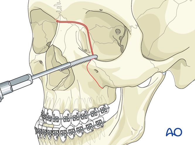 Le Fort II osteotomy for Bilateral cleft lip and/or palate