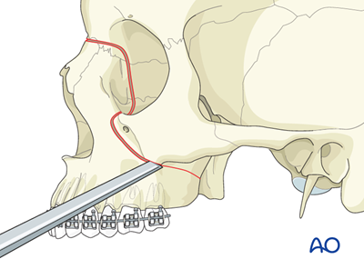 Le Fort II osteotomy for Unilateral cleft lip and/or palate ...