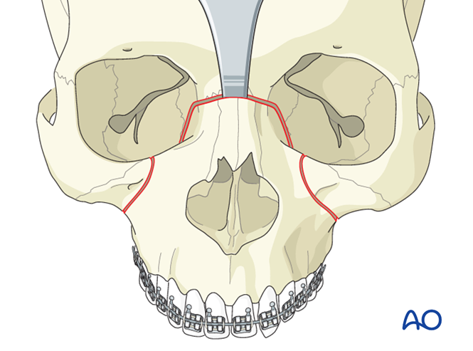 Le Fort II osteotomy for Syndromic synostosis