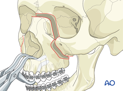 Le Fort II osteotomy for Bilateral cleft lip and/or palate