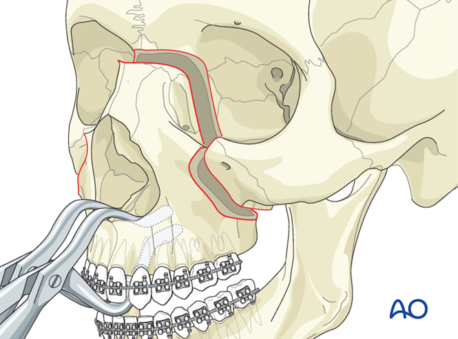 Le Fort II osteotomy for Unilateral cleft lip and/or palate ...