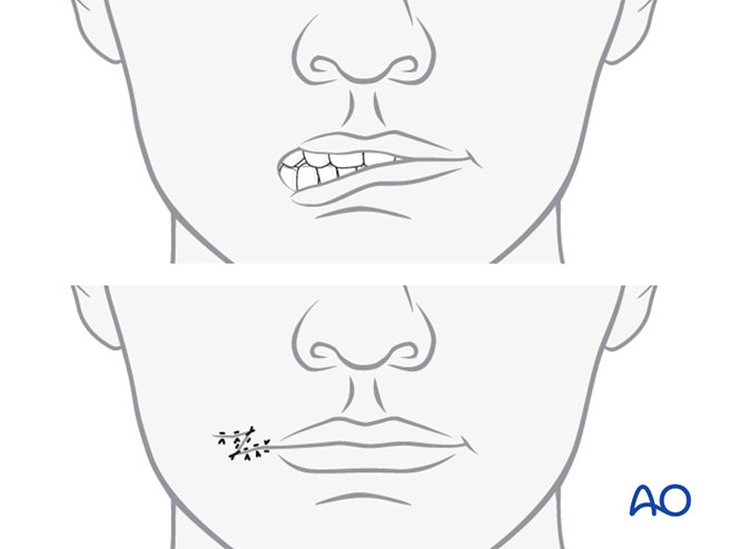 Correction of macrostomia for Pruzansky III