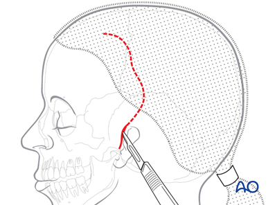 Lateral movement of mandibular ramus and condyle for Pruzansky IIb
