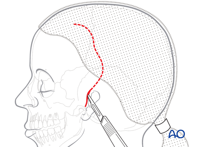 Lateral movement of mandibular ramus and condyle for Pruzansky IIb