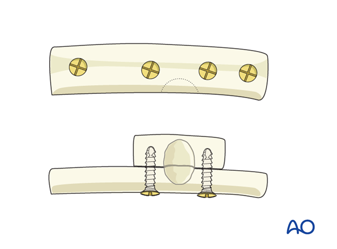 Construction of Zygomatic arch and Glenoid fossa for Pruzansky III