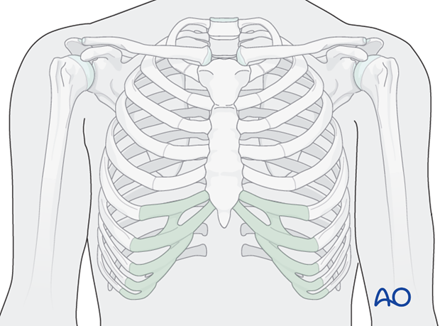 Construction of Zygomatic arch and Glenoid fossa for Pruzansky III