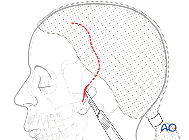 Construction of mandibular ramus and condyle for Pruzansky III