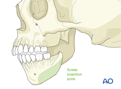 Construction of mandibular ramus and condyle for Pruzansky III