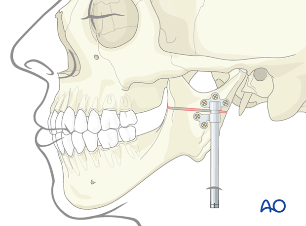 Distraction Osteogenesis Of Mandibular Ramus For Pruzansky Iii