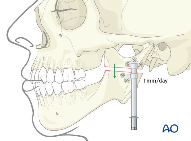 Distraction osteogenesis of mandibular ramus for Pruzansky III