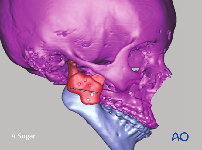 Distraction osteogenesis of mandibular ramus for Pruzansky III