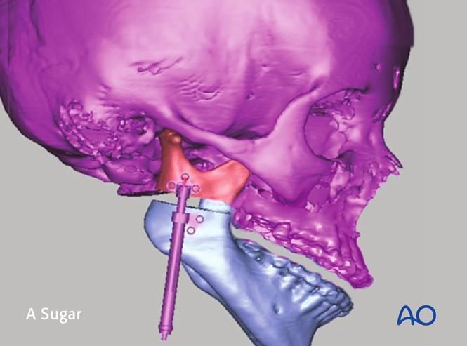 Distraction osteogenesis of mandibular ramus for Pruzansky III