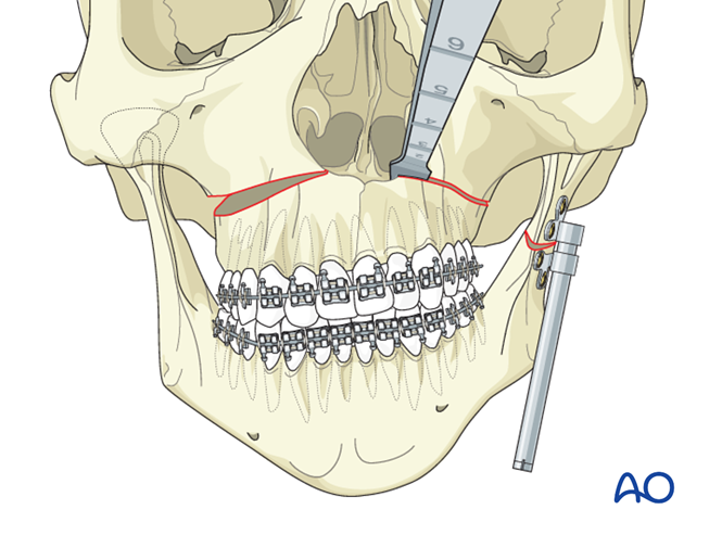 Bimaxillary distraction osteogenesis for Pruzansky IIa