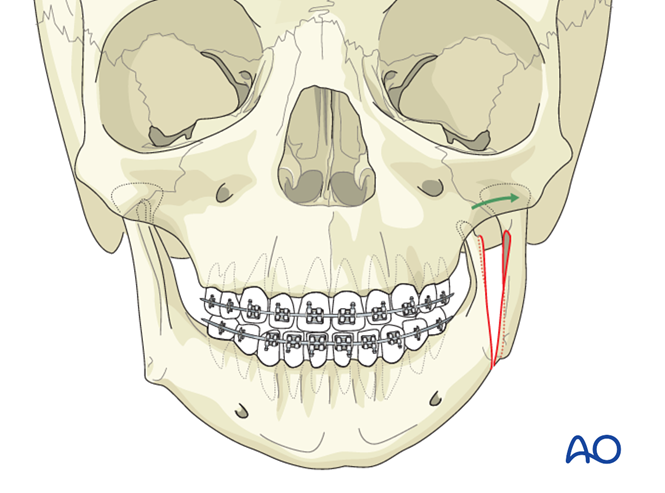 Lateral movement of mandibular ramus and condyle for Pruzansky IIb