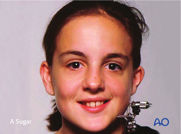 Lateral augmentation by distraction osteogenesis for Pruzansky III