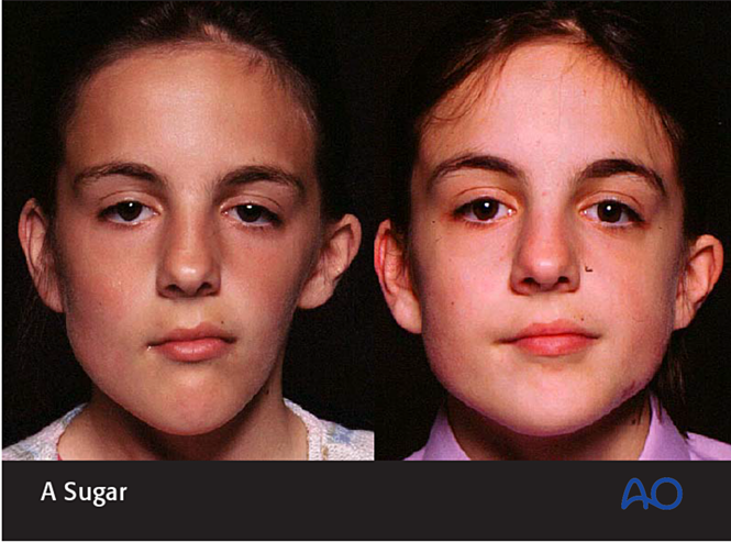 Lateral augmentation by distraction osteogenesis for Pruzansky III