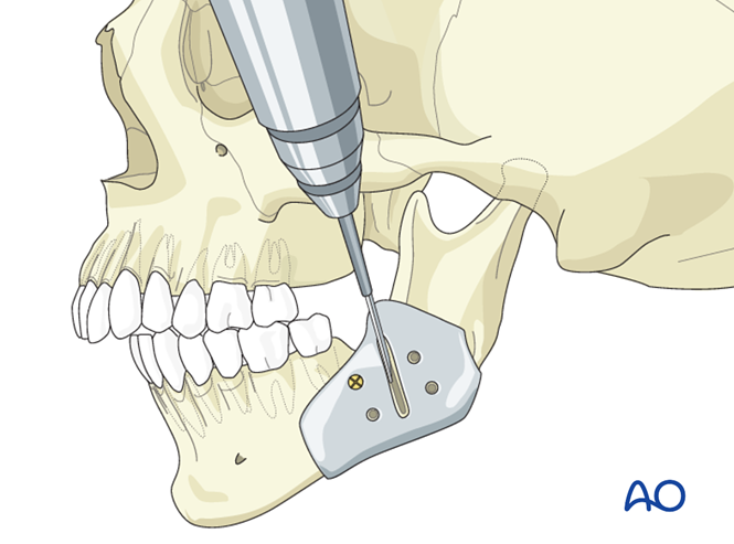 Mandibular advancement by distraction osteogenesis for Pruzansky IIb
