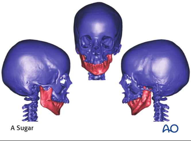 Mandibular advancement by distraction osteogenesis for Pruzansky IIb