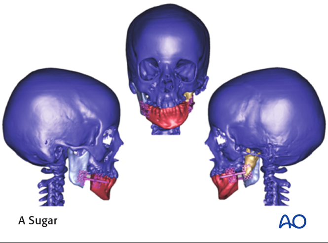 Mandibular advancement by distraction osteogenesis for Pruzansky IIb