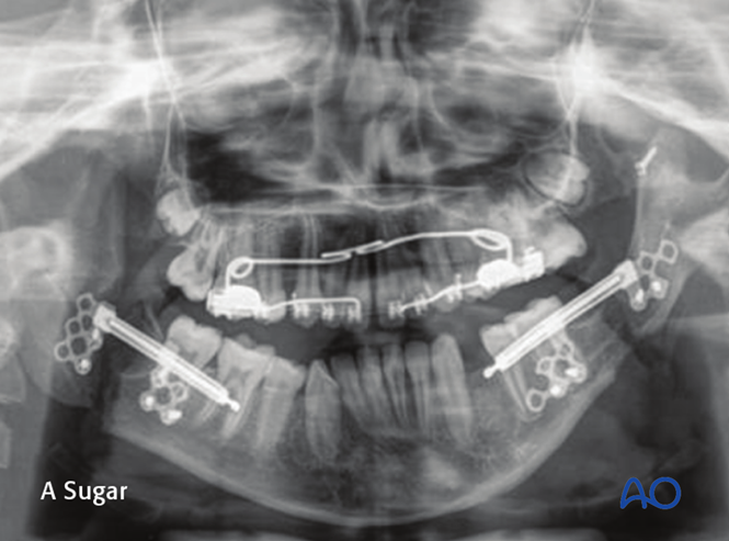 Mandibular advancement by distraction osteogenesis for Pruzansky IIb