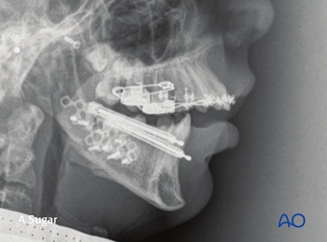 Mandibular advancement by distraction osteogenesis for Pruzansky IIb