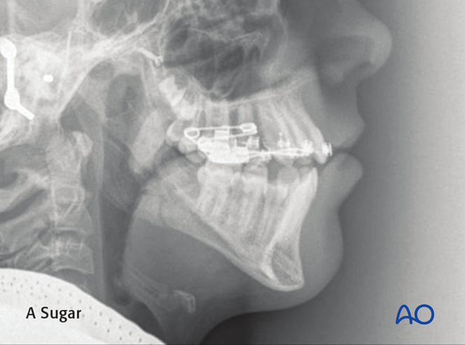 Mandibular advancement by distraction osteogenesis for Pruzansky IIb