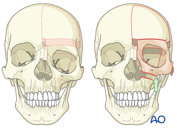 Four wall box osteotomy for Pruzansky IIa