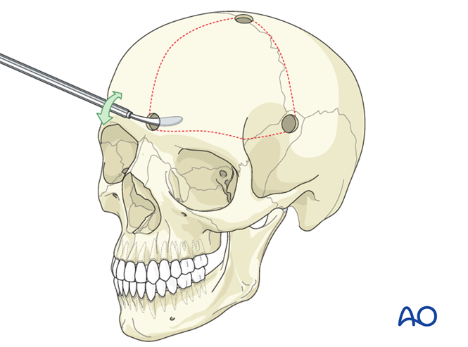 Four wall box osteotomy for Pruzansky IIa
