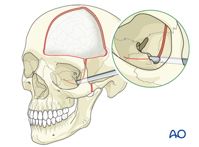 Four wall box osteotomy for Pruzansky IIa