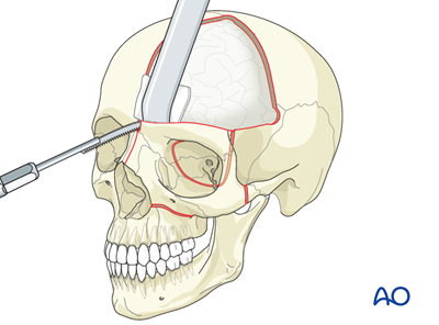 Four wall box osteotomy for Pruzansky IIa