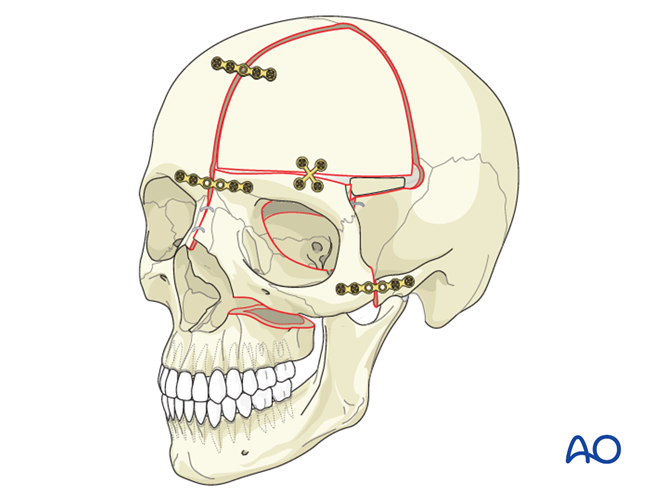 Four wall box osteotomy for Pruzansky IIb