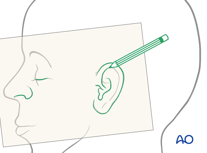 Autogenous ear construction for Pruzansky I