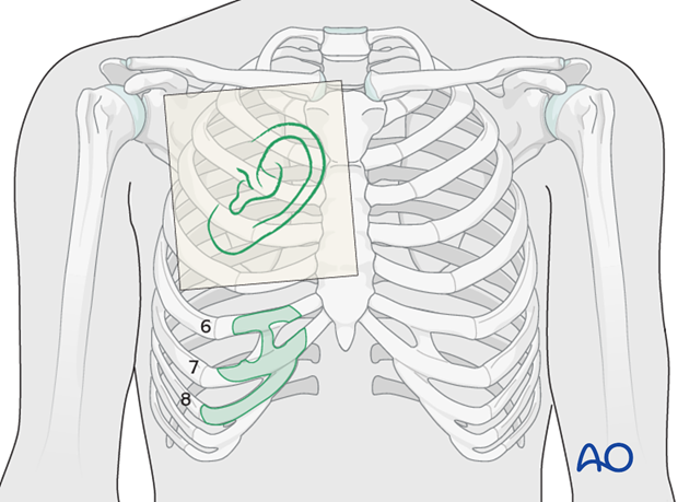 Autogenous ear construction for Pruzansky I