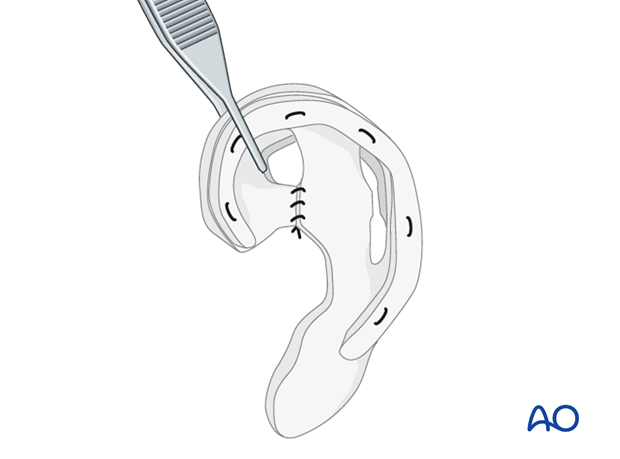Autogenous ear construction for Pruzansky I