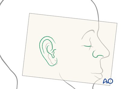 Autogenous ear construction for Pruzansky I