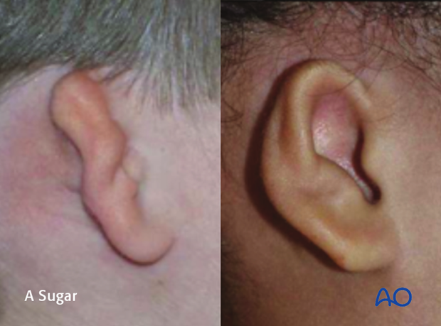 Autogenous ear construction for Pruzansky I