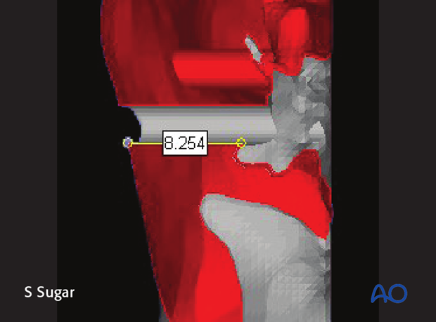 Bone anchored ear prosthesis for Pruzansky IIa