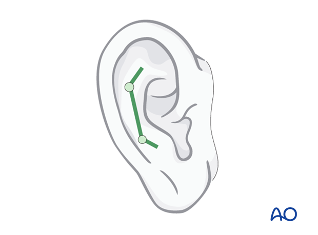 Bone anchored ear prosthesis for Pruzansky IIb