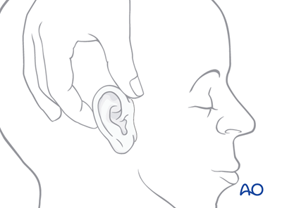 Bone anchored ear prosthesis for Pruzansky IIb