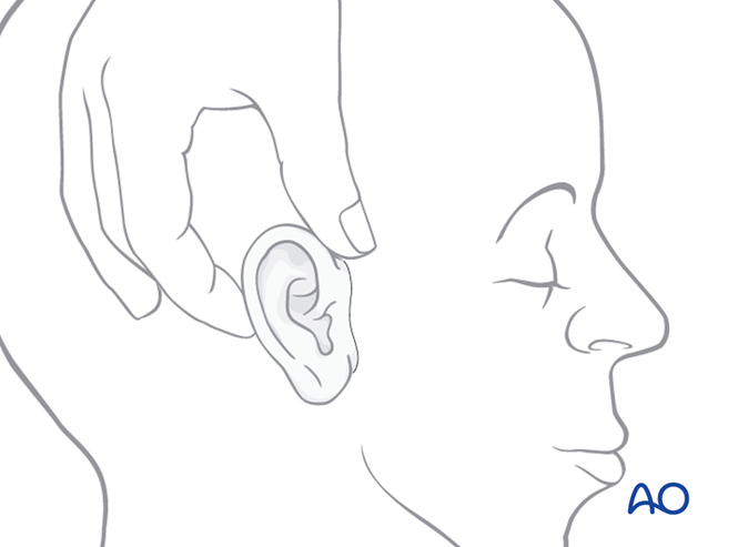 Bone anchored ear prosthesis for Pruzansky IIb