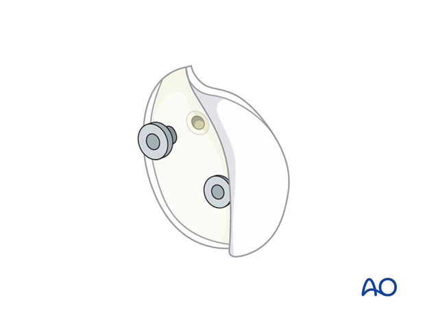 Bone anchored ear prosthesis for Pruzansky IIb