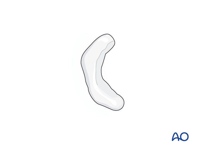 Bone anchored ear prosthesis for Pruzansky IIb